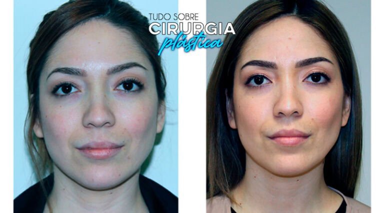 Tudo Sobre Bichectomia – Guia Definitivo - Tudo Sobre Cirurgia Plástica